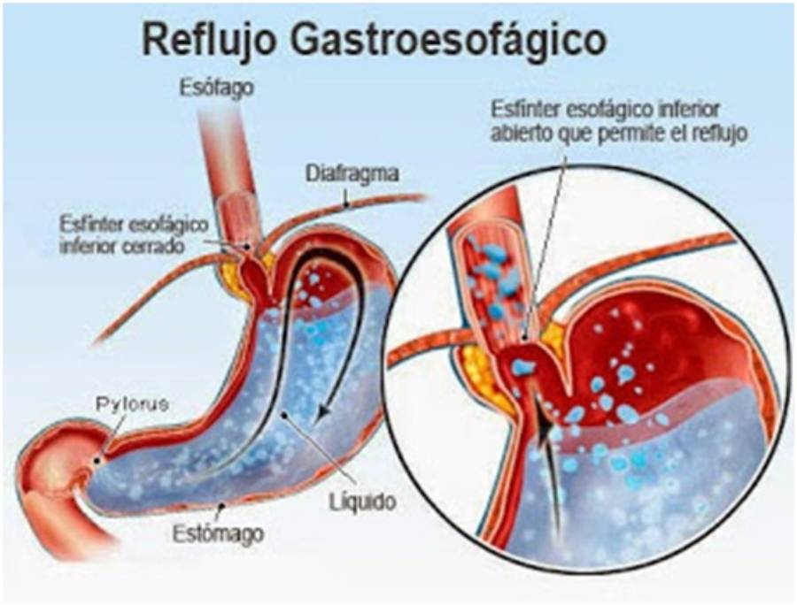 Esófago de Barret | Blogs Quirónsalud