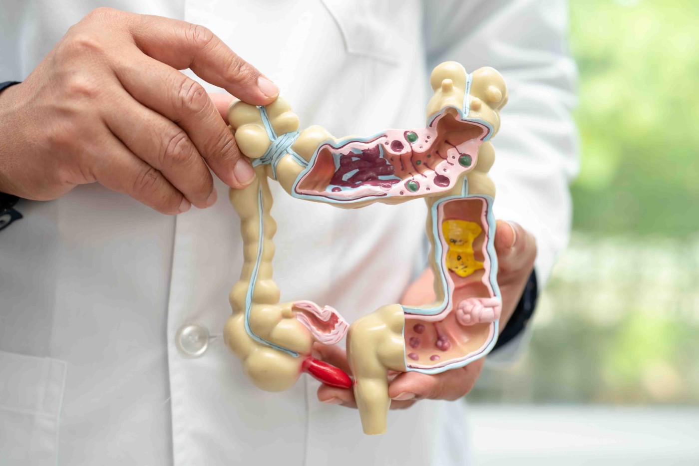Pólipos de colon: qué son, por qué aparecen y cómo la colonoscopia ...