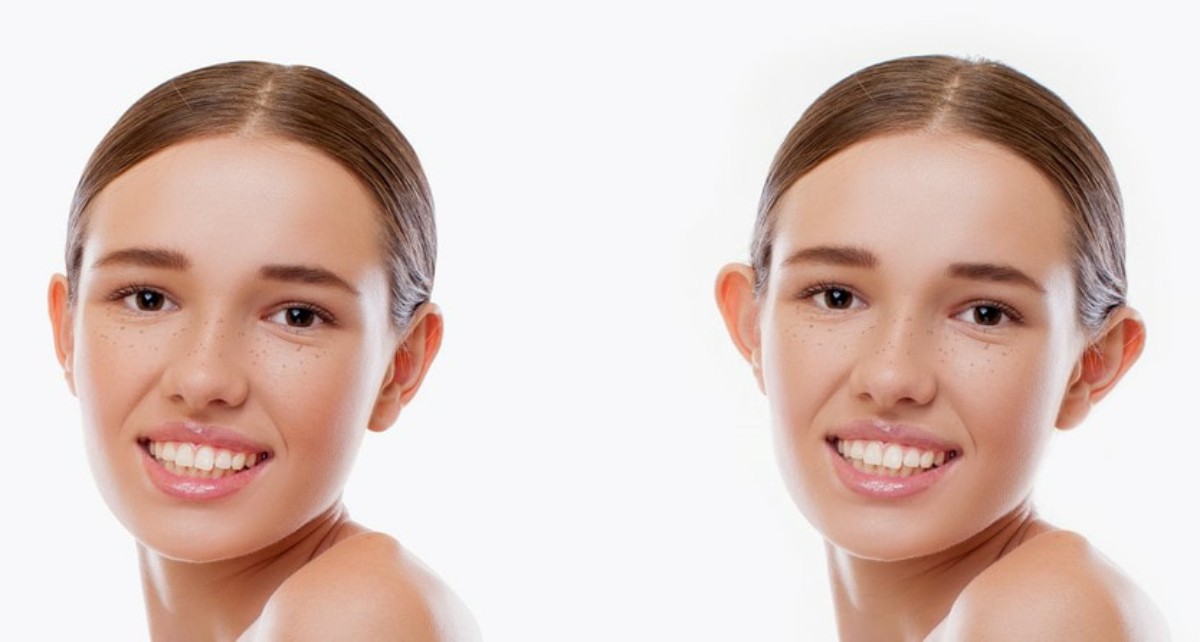 Auriculoplastia, la cirugía estética de las orejas | Blogs Quirónsalud