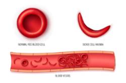La anemia de células falciformes: Una enfermedad hereditaria de la ...