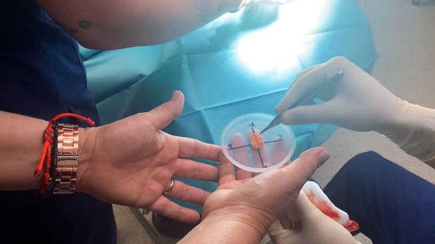 La cirugía de Mohs | Blogs Quirónsalud