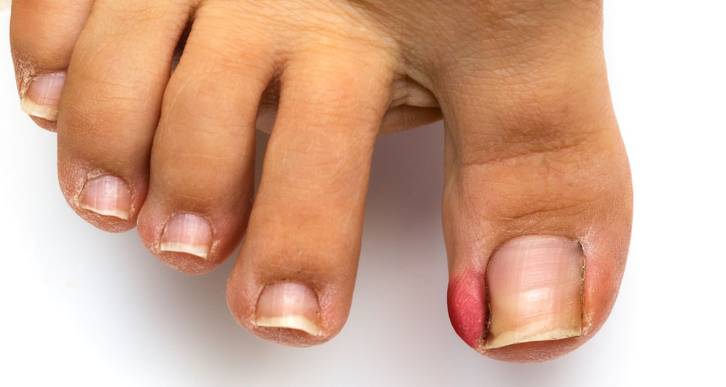 Patologías de las uñas (II parte) | Blogs Quirónsalud