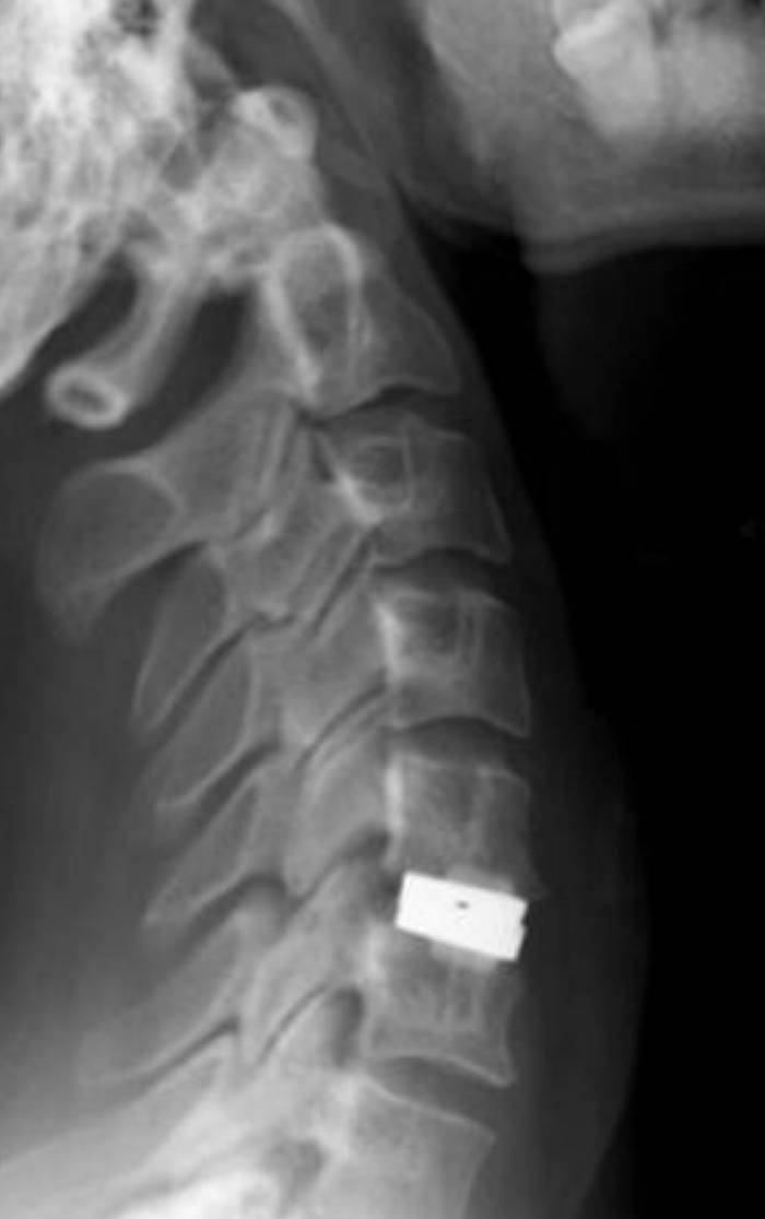 Prótesis para la sustitución de discos intervertebrales | Blogs Quirónsalud