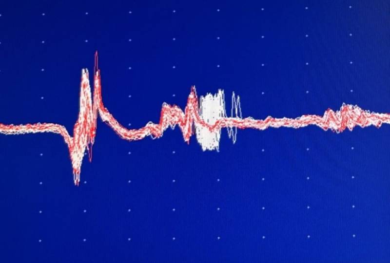 Electromiografía de Fibra aislada o Fibra única (Jitter) | Hospital ...