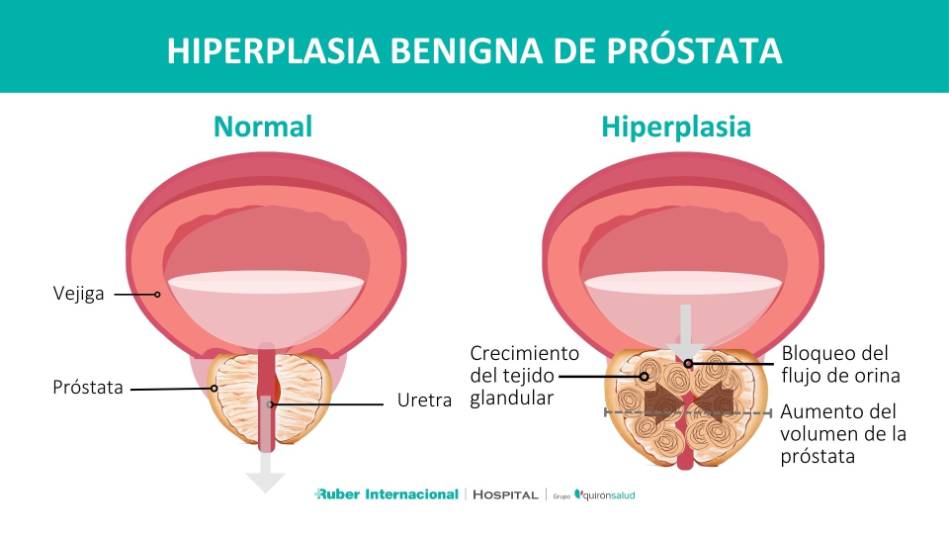 Hiperplasia benigna de próstata: tratamiento mediante enucleación con ...