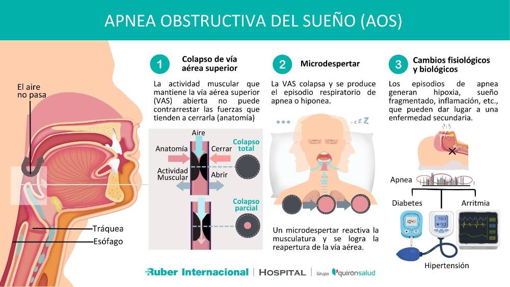 Apnea Obstructiva del Sueño (AOS): Causas y Síntomas frecuentes