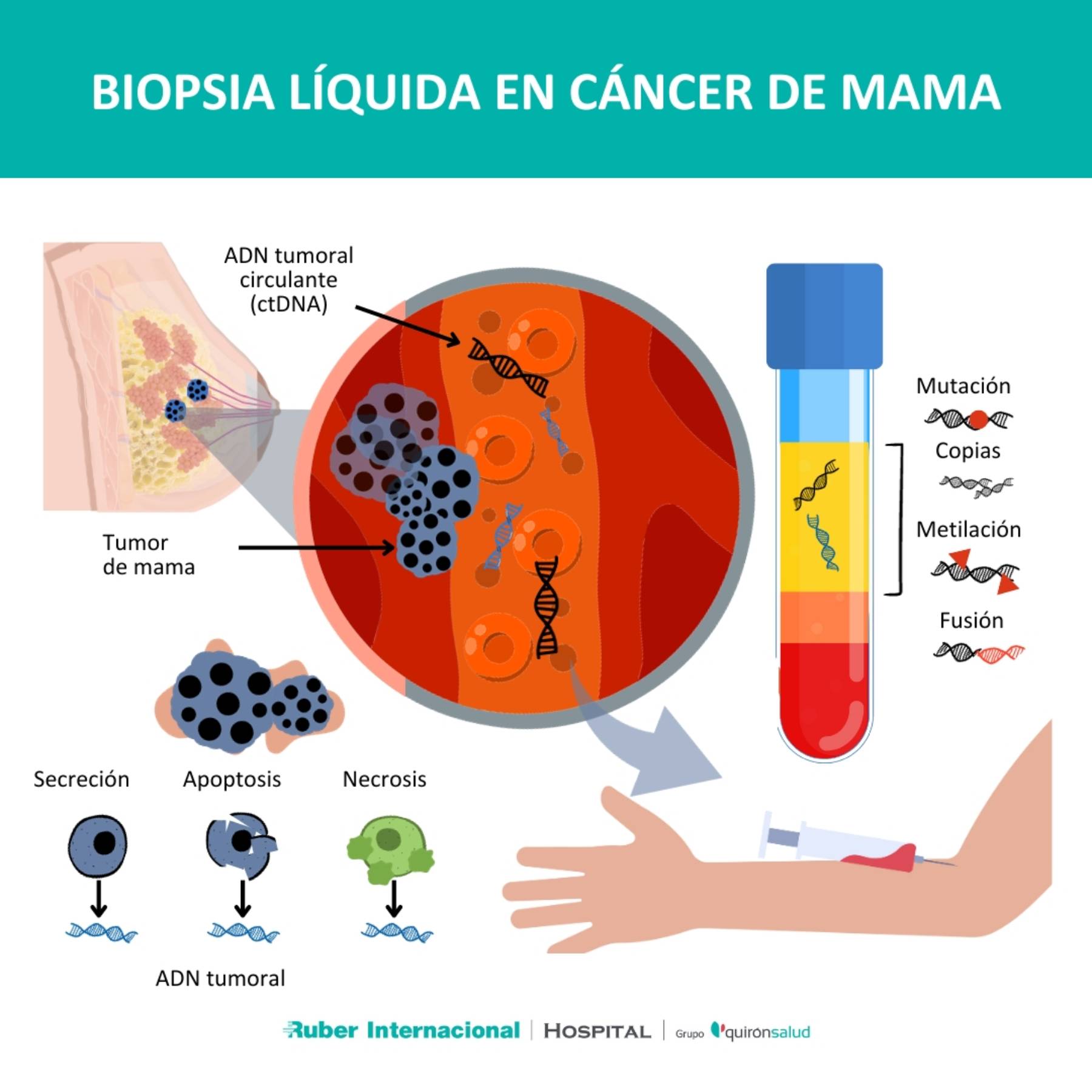 Biopsia líquida en el cáncer de mama