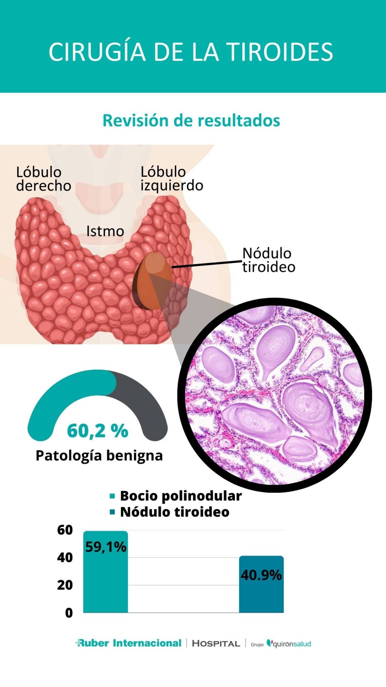 Cirugía de la Glándula Tiroides