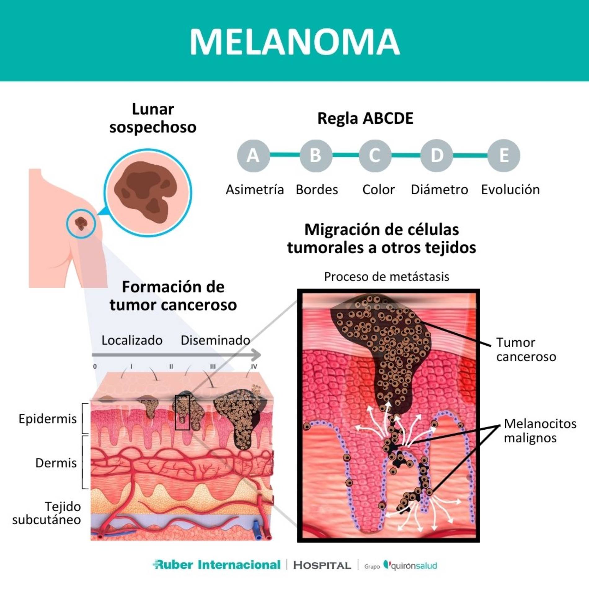 Día mundial contra el melanoma: Conciencia y prevención del cáncer de piel