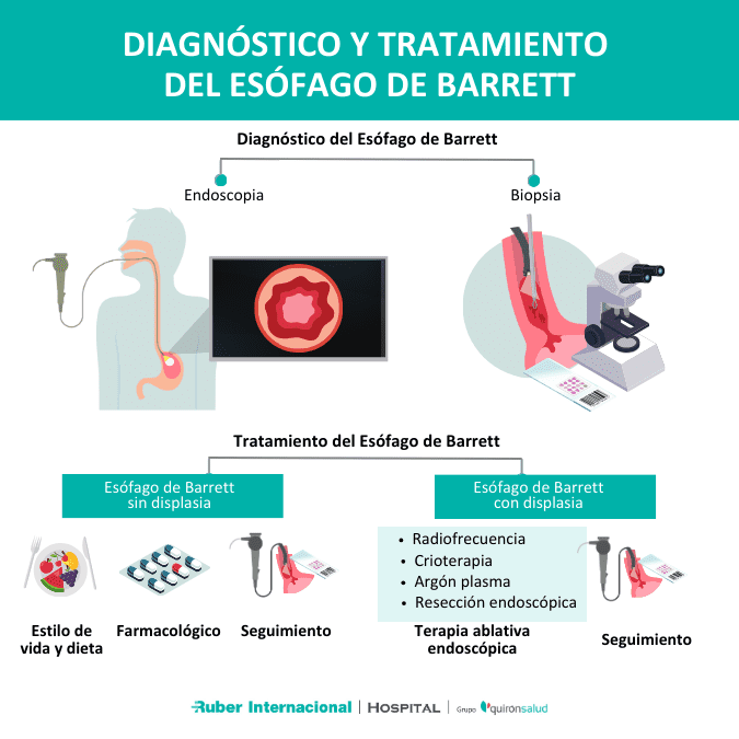Esófago de Barrett: Causas, síntomas, diagnóstico y tratamiento