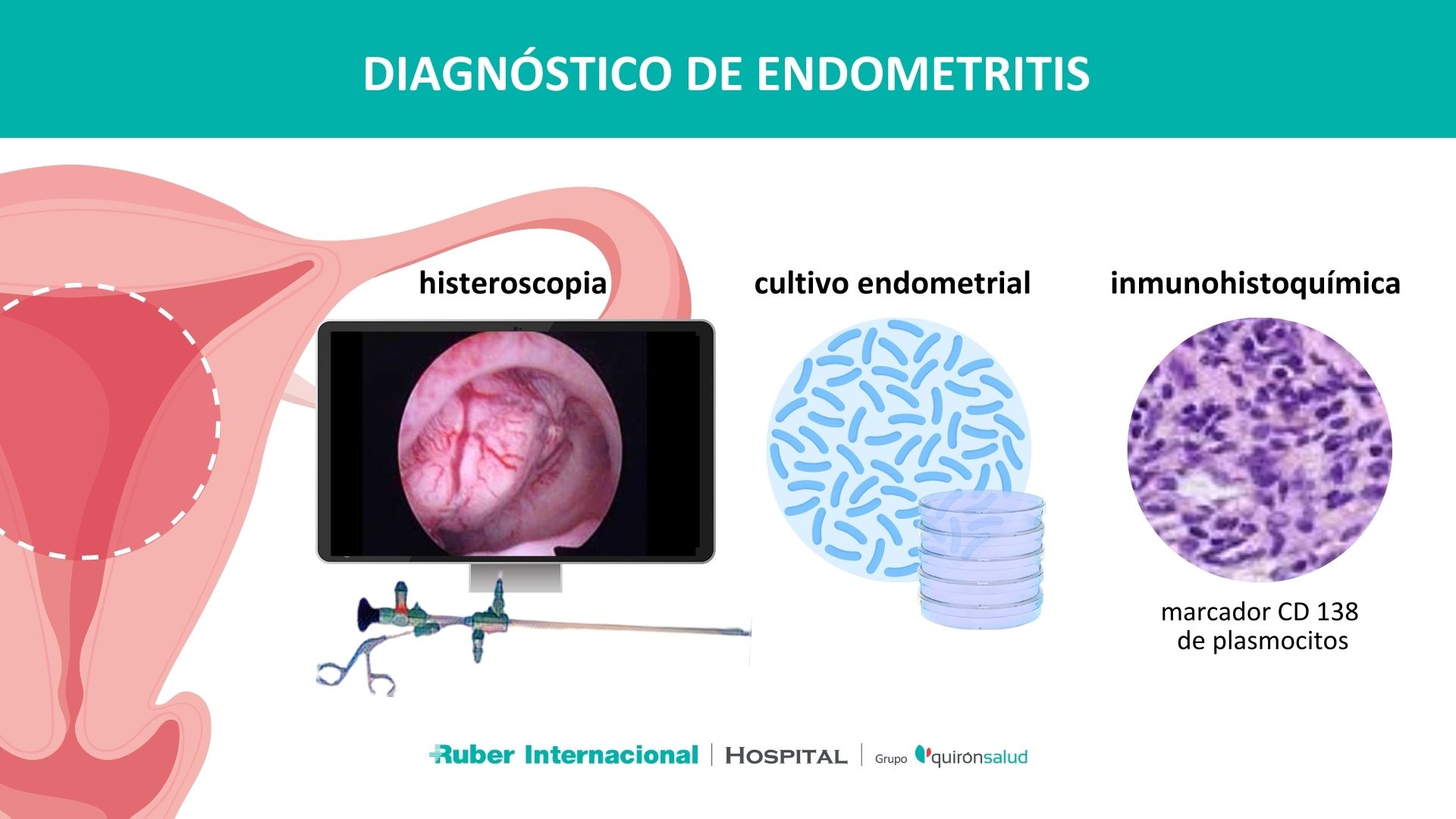 Evaluación funcional del endometrio en la infertilidad