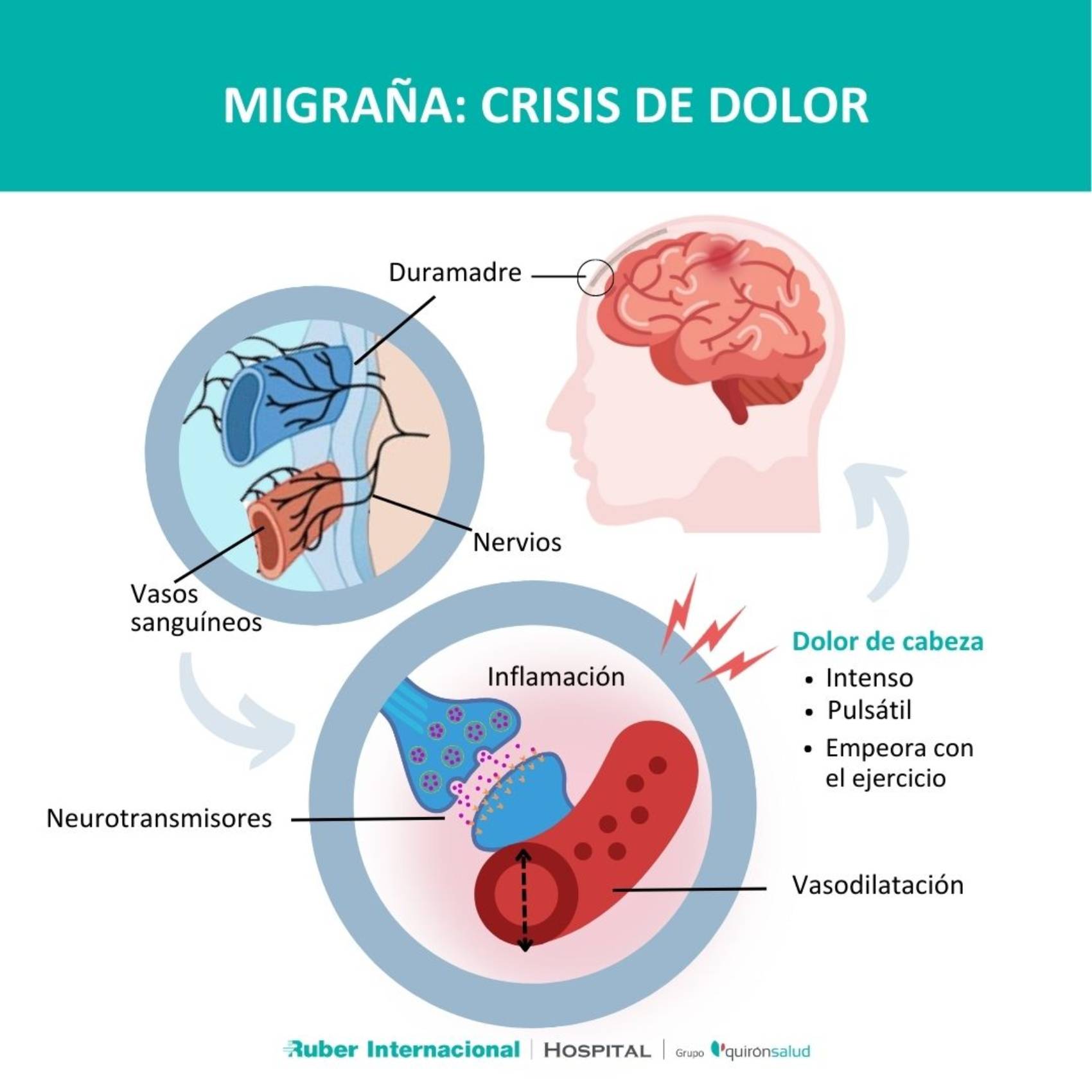 Migraña: causas, diagnóstico y tratamiento.