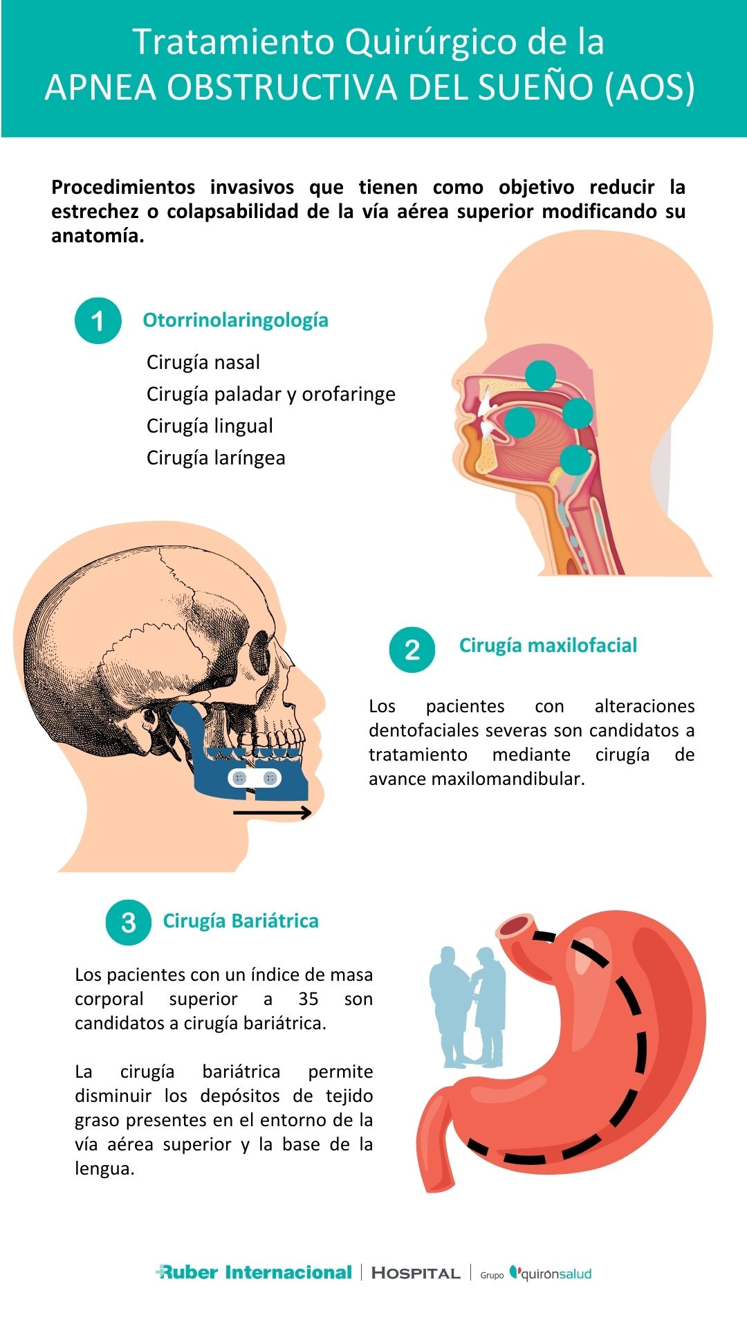 Tratamiento quirúrgico de la Apnea obstructiva del sueño (AOS)