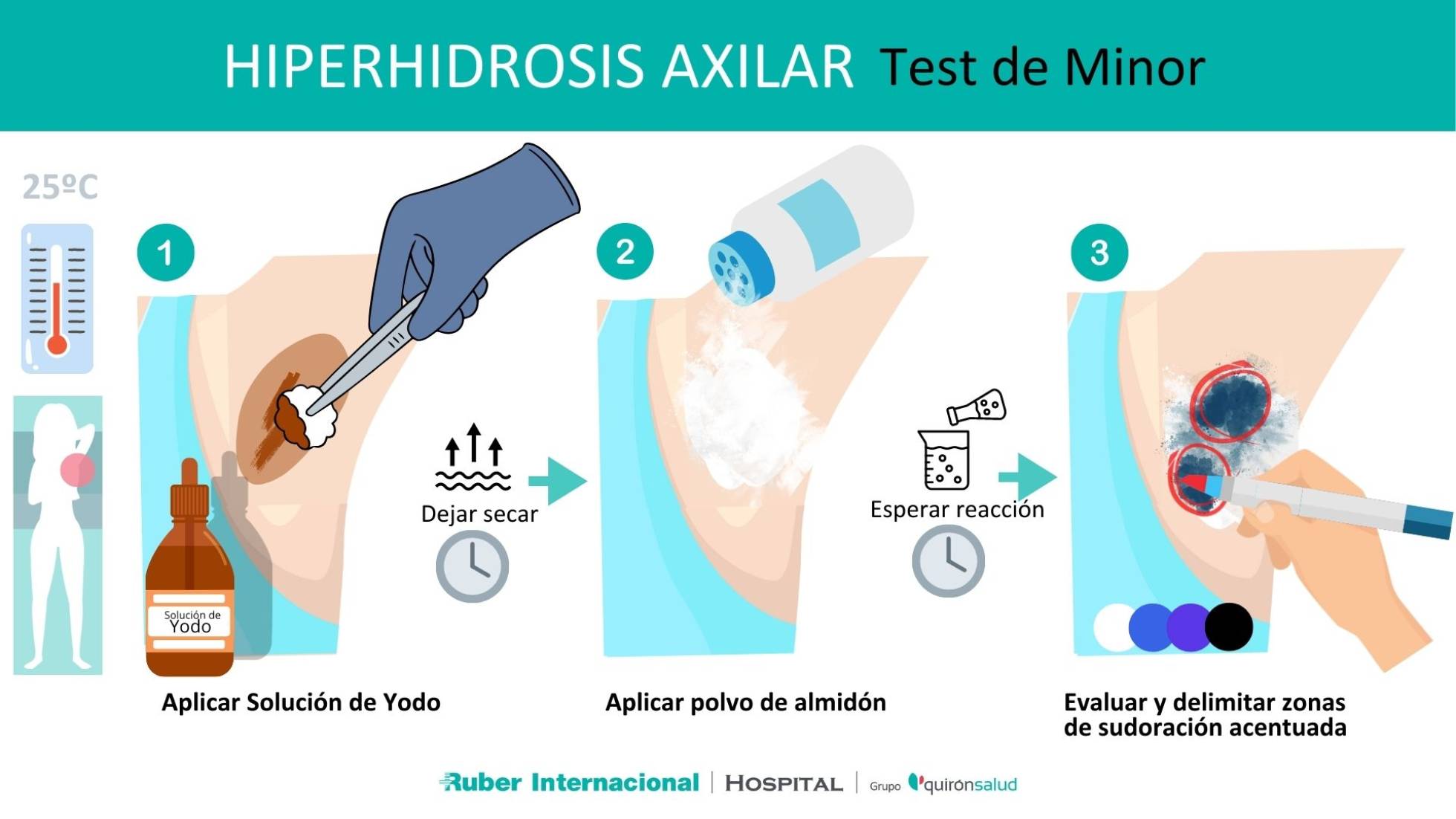 Tratamiento eficiente del exceso de sudoración axilar o hiperhidrosis ...