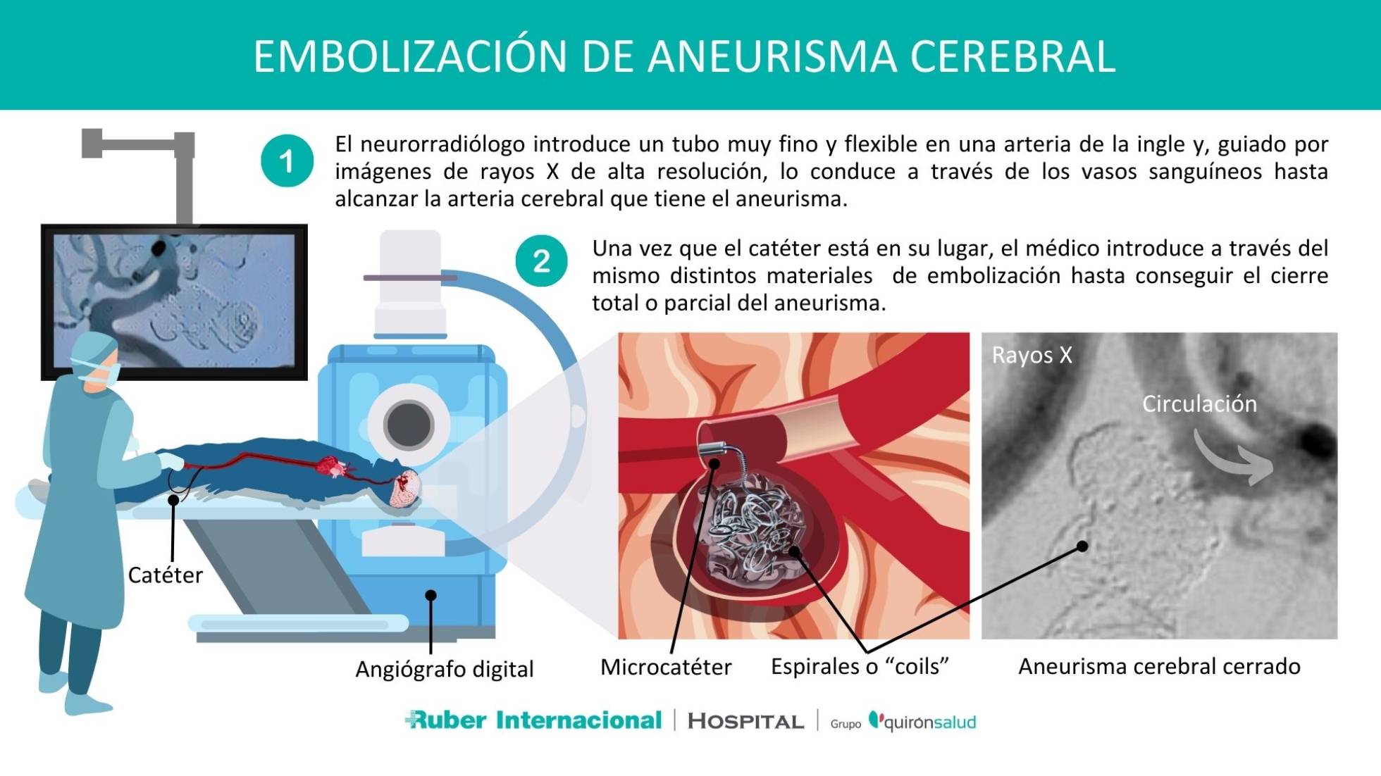 Aneurisma cerebral: Tratamiento endovascular mínimamente invasivo