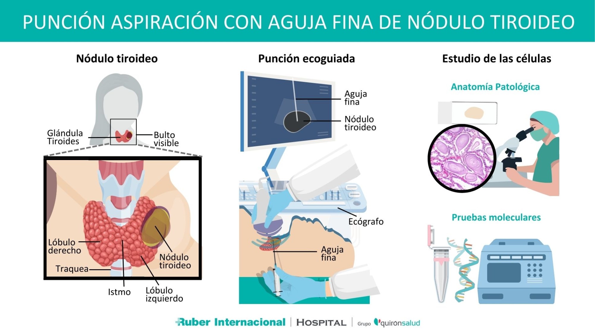 Nódulo Tiroideo: Tratamiento ambulatorio mediante radiofrecuencia sin ...