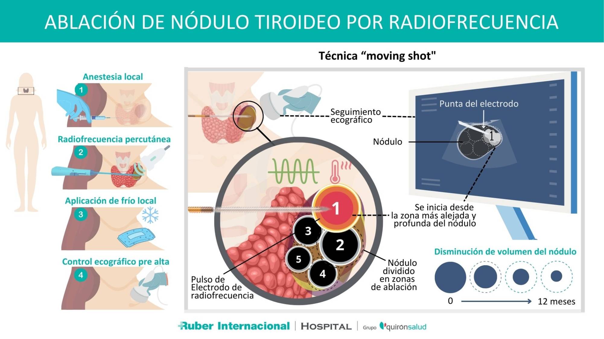 Nódulo Tiroideo: Tratamiento ambulatorio mediante radiofrecuencia sin ...
