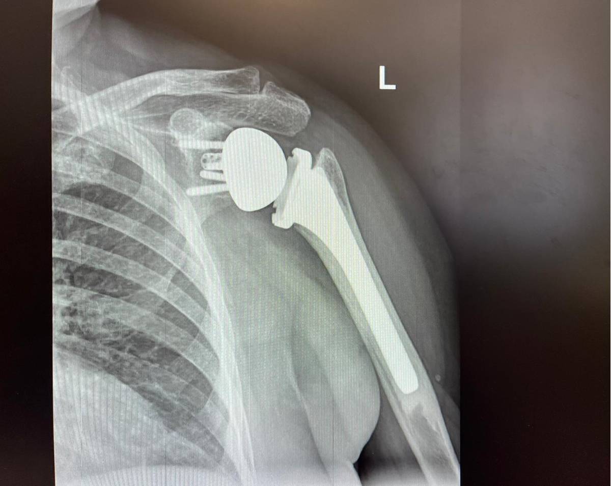 Así evolucionan las prótesis de hombro: se adaptan durante la cirugía y ...