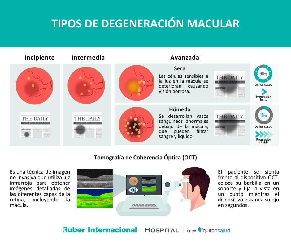 Degeneración Macular: Causas, Síntomas, Diagnóstico y Tratamiento