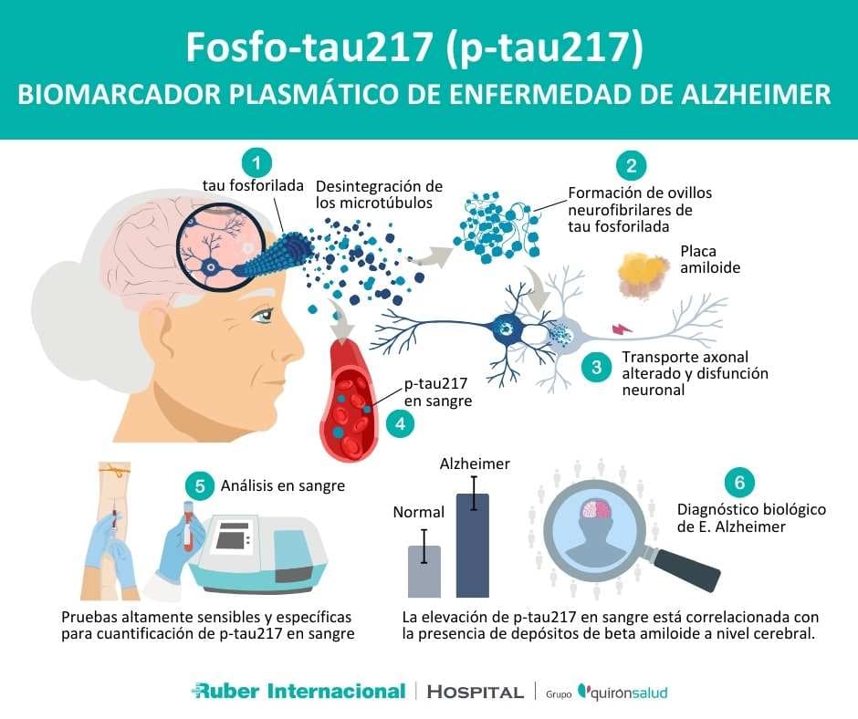 Diagnóstico del Alzheimer: Biomarcador fosfo-tau217