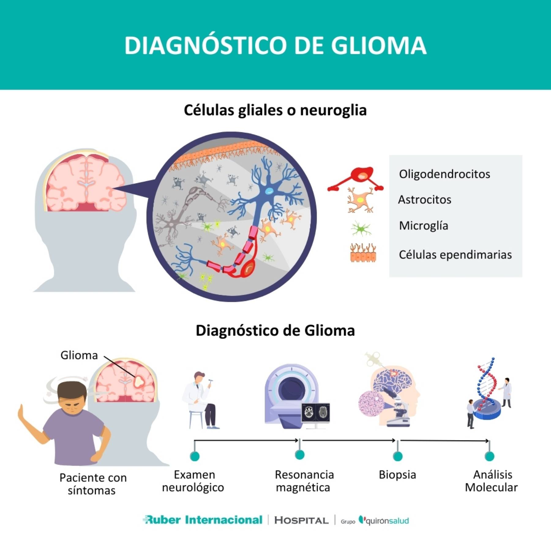 Glioma de bajo grado: Un tumor cerebral que requiere una atención ...