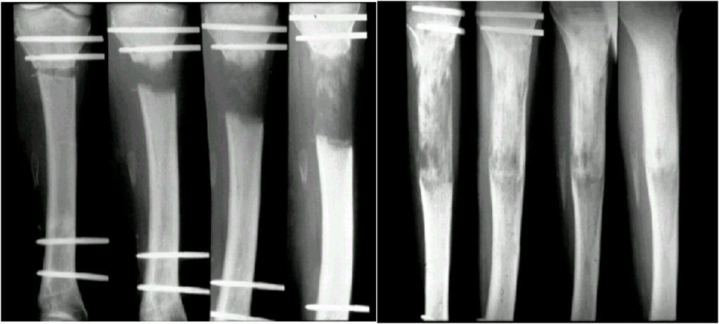 Defectos Óseos | Hospital Quirónsalud Málaga