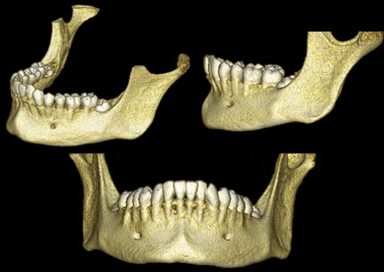 Tumores craneo-maxilofacial | Hospital Universitario Quirónsalud Madrid