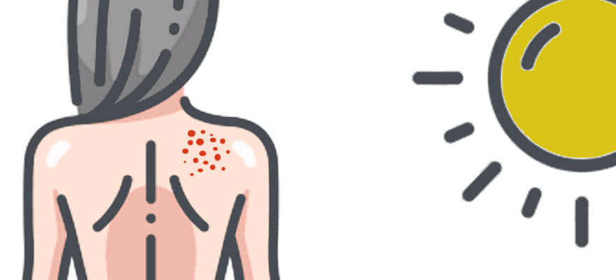 ¿Qué es la fotodermatosis? | Blogs Quirónsalud