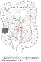Postoperatorio de la cirugía de cáncer de colon | Blogs Quirónsalud