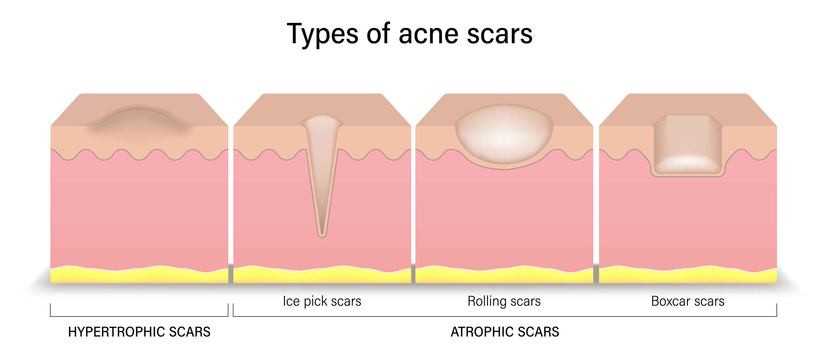 Tratamiento de las cicatrices de acné | Blogs Quirónsalud