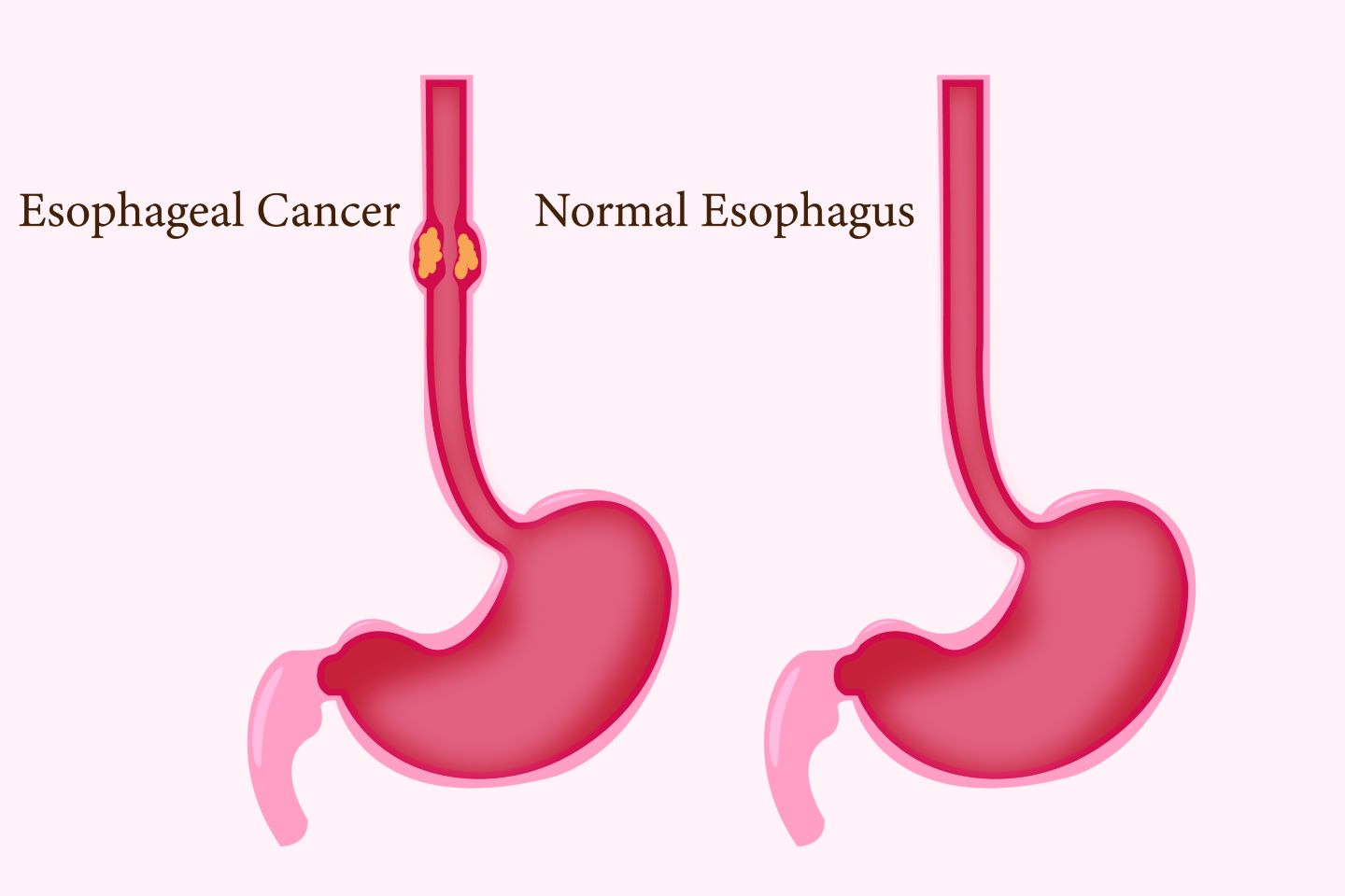 Diagnosticar y tratar un cáncer en el esófago. ¿Cómo prevenirlo ...