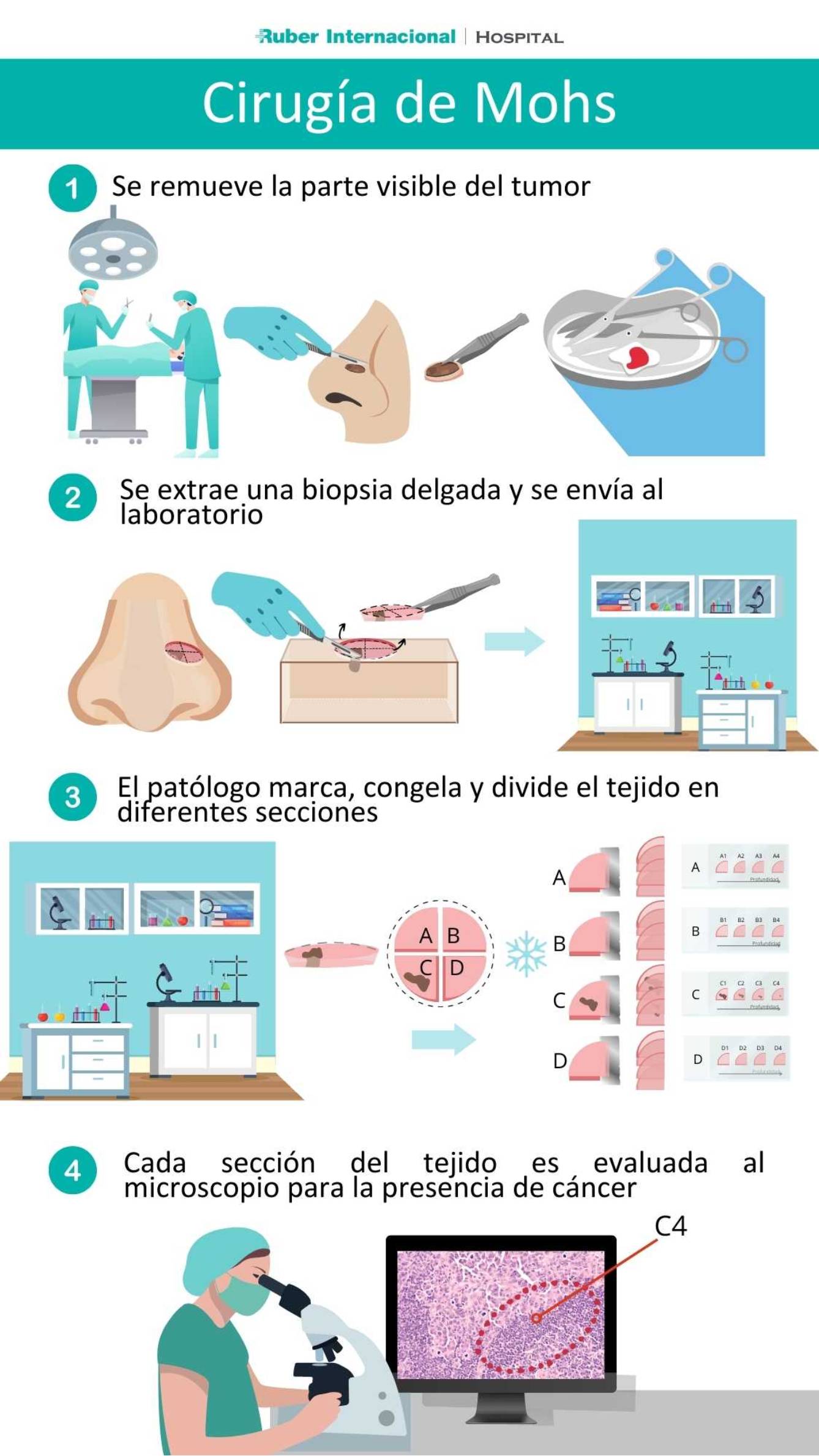 Cirugía de Mohs | Tratamiento de cáncer de piel
