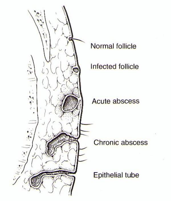 Sinus pilonidal | Hospital Universitario Ruber Juan Bravo