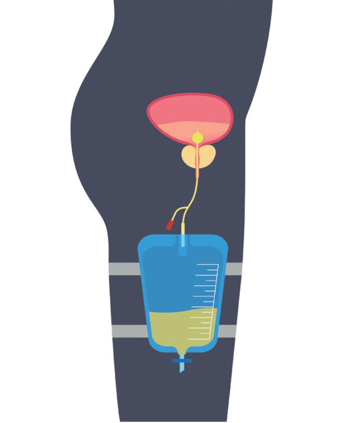Educación al paciente. Alta con sondaje vesical | Hospital Quirónsalud ...