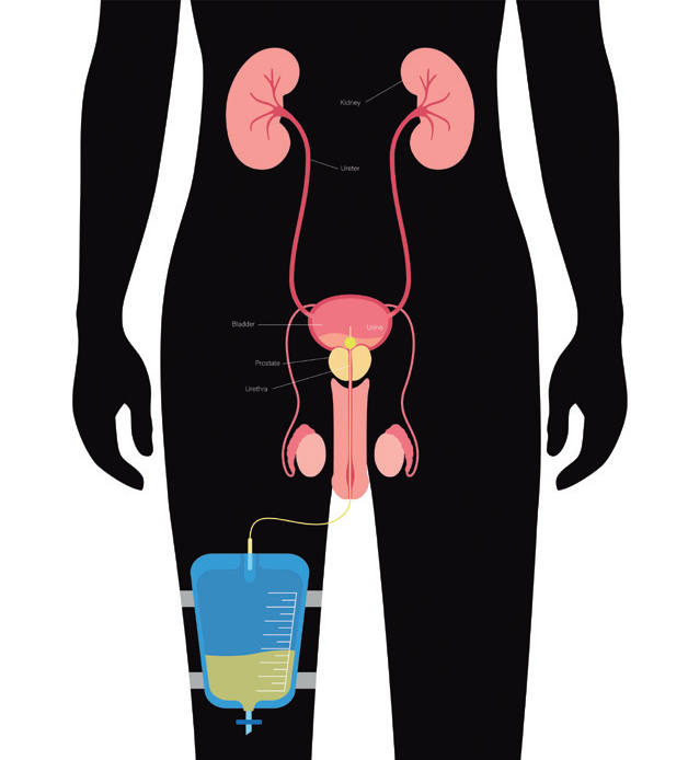Alta con sondaje vesical | Hospital Quirónsalud Valle del Henares